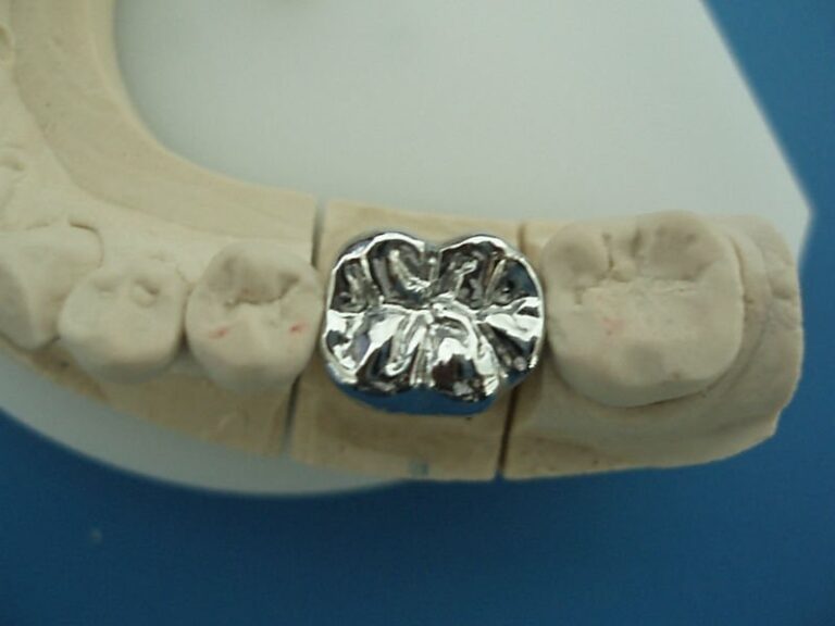 Full Cast Crown - Edent Dental Lab